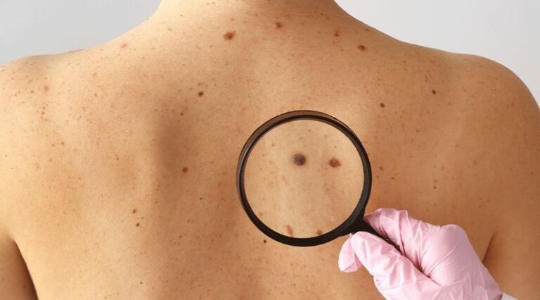Como identificar quando uma pinta pode ser câncer de pele?